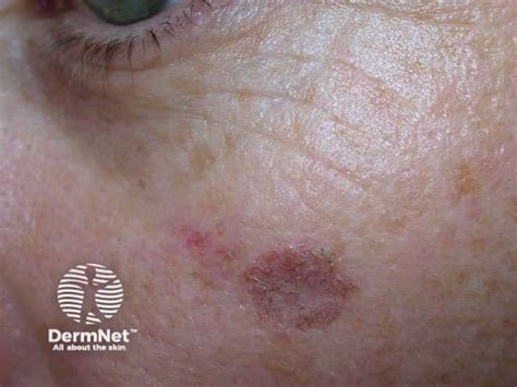 Lichenoid Actinic Keratosis Gallery
