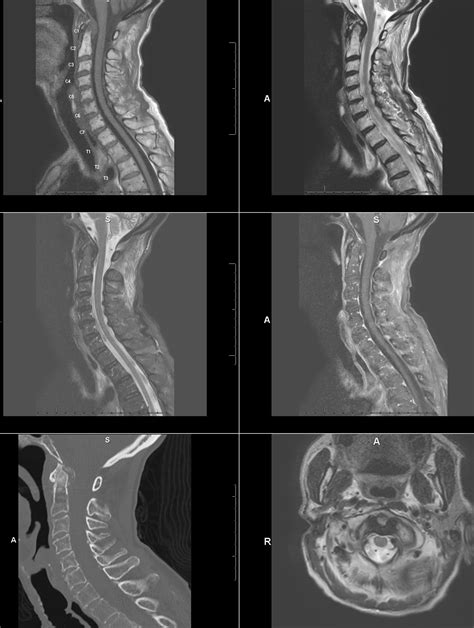 Cppd Crown Dens Syndrome Ocad