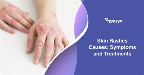 6 Common Types Of Skin Rashes Symptoms And Treatments Eroppa