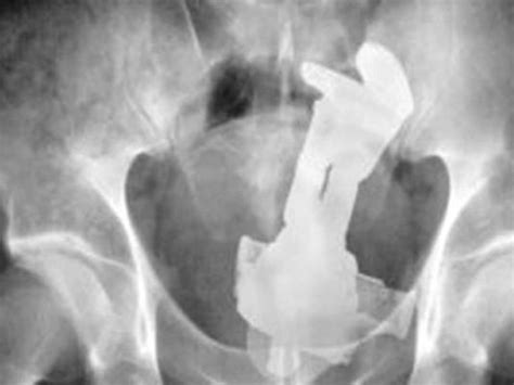 Objetos extraños que han encontrado los médicos en Urgencias