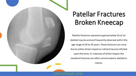 Patella Fracture Classification Fracture Of The Inferior Pole Of The