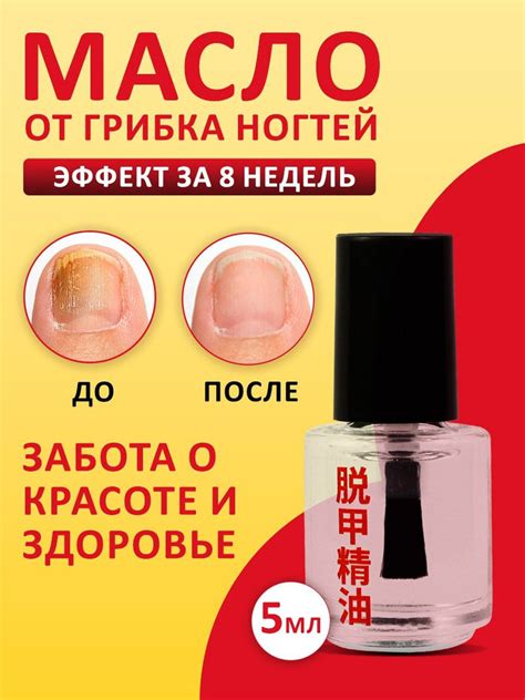 Средство от грибка ногтей на ногах стоп онихолизис 5 мл купить на Ozon по низкой цене 1900145305