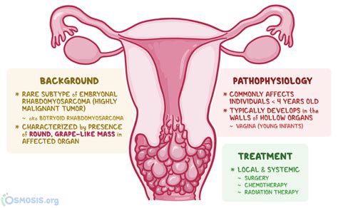 Sarcoma Botryoides What Is It Treatment And More