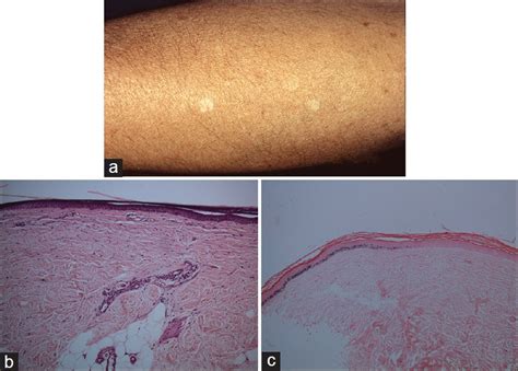 Clinicopathological Correlation Of Acquired Hypopigmentary Disorders