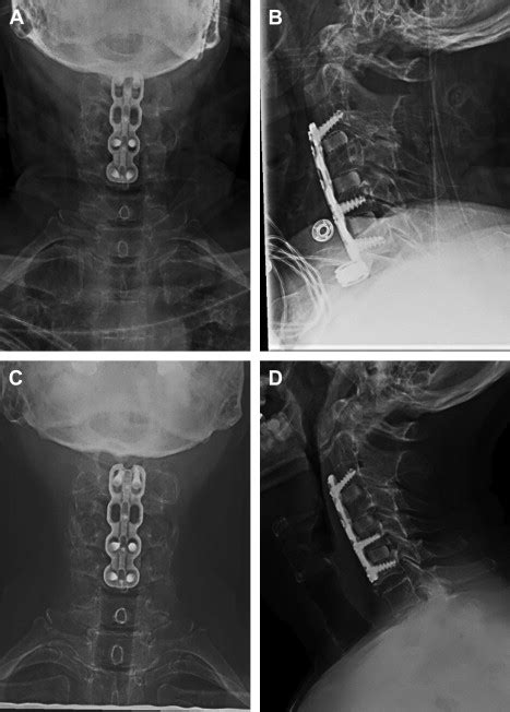 Dynamic Constructs For Spinal Fusion An Evidence Based Review Musculoskeletal Key