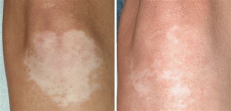 The Use Of Excimer Phototherapy In The Treatment Of Various Skin Diseases