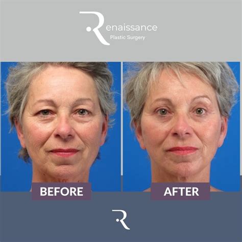 Facelift Before And After Renaissance Plastic Surgery
