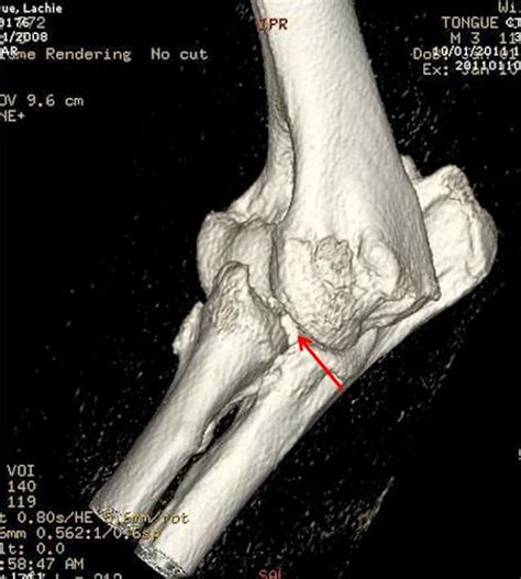 Elbow Fragmented Medial Coronoid Process 07 3d Reconstruction Ct In