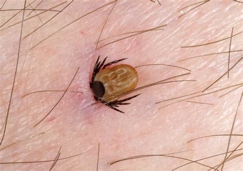 Best Ticks On Humans Images On Pinterest