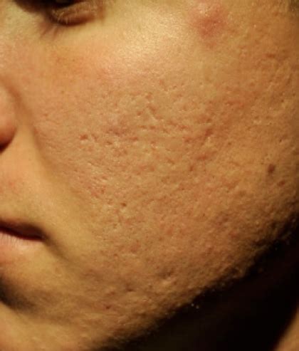 ProCell Microchanneling Therapy Marin County Plastic Surgery Specialists