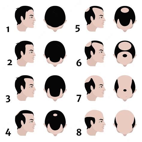 Everything You Need To Know About Baldness Ziering Medical