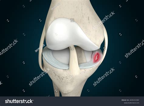 Meniscus Tear 3d Rendering Knee Anatomy Stock Illustration 2076723787