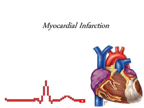 Myocardial Infarction 1 Outlines Introduction Pathophysiology Causes Clinical