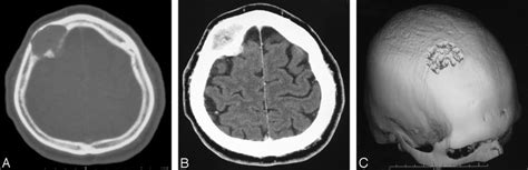 Ct Scan With Bone Window A Demonstrates A Right Sided Frontoparietal