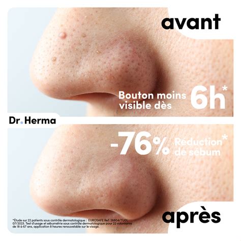 Patch Pour Le Nez Patch Anti Imperfections Dr Herma