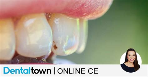 White Spot What Now An Update On Incipient Caries Treatments