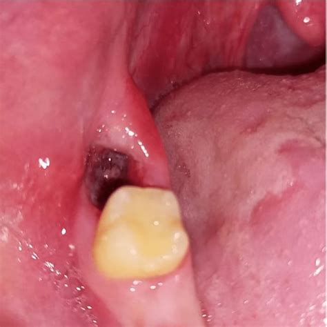 Normal Socket Vs Dry Socket After Tooth Extraction Key Differences