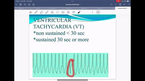 Tachyarrythmia 2 Youtube
