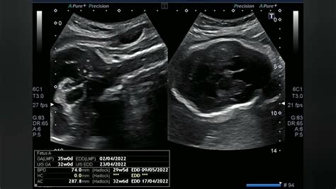 Ultrasound Video Showing Arnold Chiari Malformation Type 2 Youtube