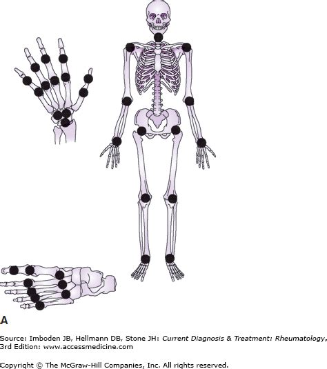 Rheumatoid Arthritis Musculoskeletal Key