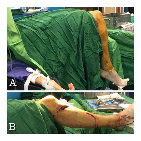 Gravity Based Minimal Invasive Plate Osteosynthesis For Proximal Tibia Fractures A Novel