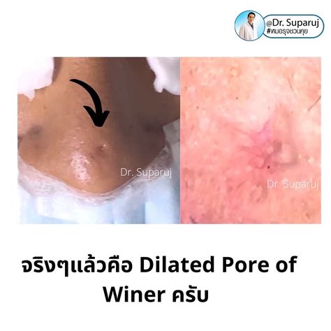 Dilated Pore Of Winer เหมือนรูหลุมสิวแต่ไม่ใช่