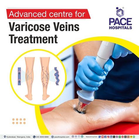 Best Hospital For Varicose Veins Treatment In Hyderabad Surgery Cost