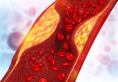 Aterosklerosis Sclerosis Foto Stok Potret And Gambar Bebas Royalti Istock