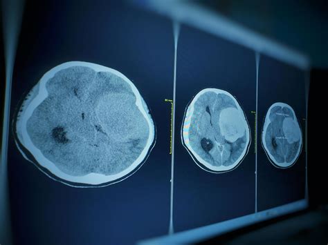 Ct Brain Diameter Hyperdensity Mass With Lobulated Surface At Extra