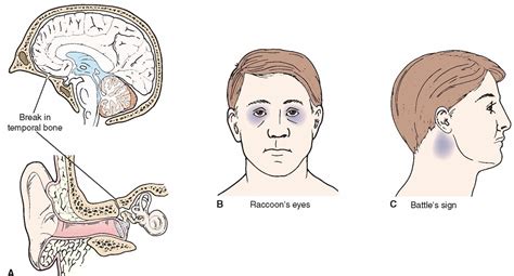 Battle Sign Definition Causes Diagnosis And Treatment