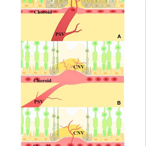 Ss Oct In A Patient With Multifocal Choroiditis A Shows Multiple Download Scientific Diagram