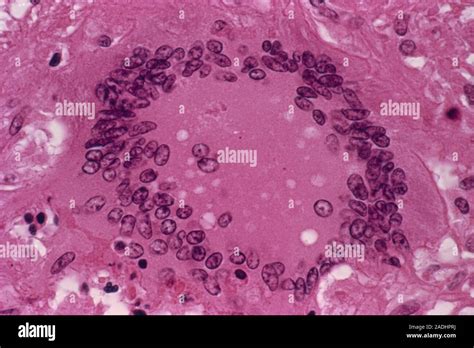 Tuberculosis Light Micrograph Of A Section Through A Lymph Node Showing A Langhans Cell Caused
