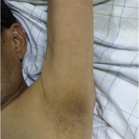 Typical Attitude Of Patient With Hyperabduction Of The Shoulder