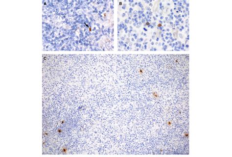 Expression Of Epstein Barr Virus Ebv Encoded Nuclear Antigen 2