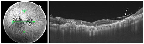 Ocular Toxoplasmosis Advances In Toxoplasma Gondii Biology Clinical