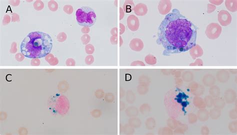 A B The Wright Giemsa Stain Of Peripheral Blood Smear Showing Blasts