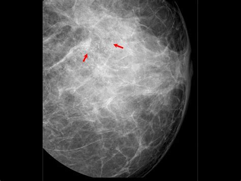 Atlas Of Breast Cancer Early Detection