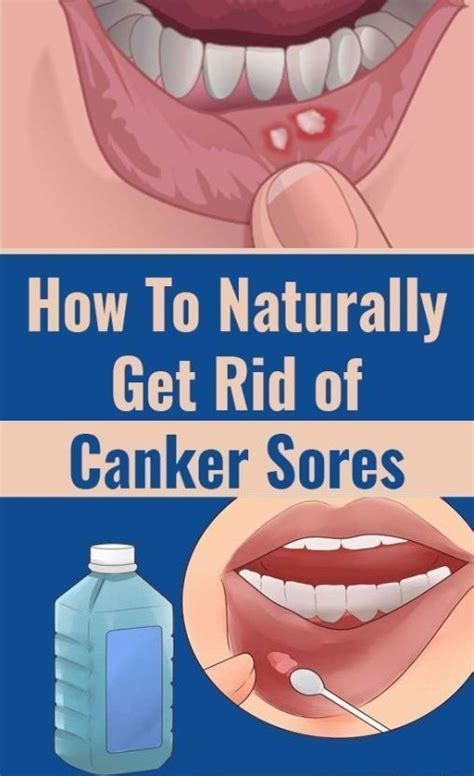 How To Help Tongue Sore At Curtis Carr Blog