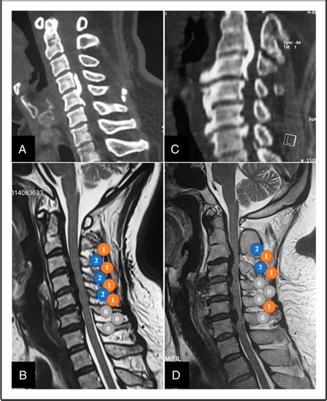 A Novel Posterior Compression Score System For Outcome Prediction In