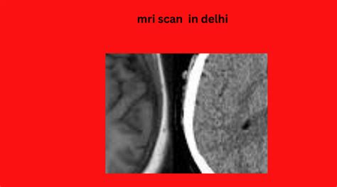 Mri Scan In Delhi Album On Imgur