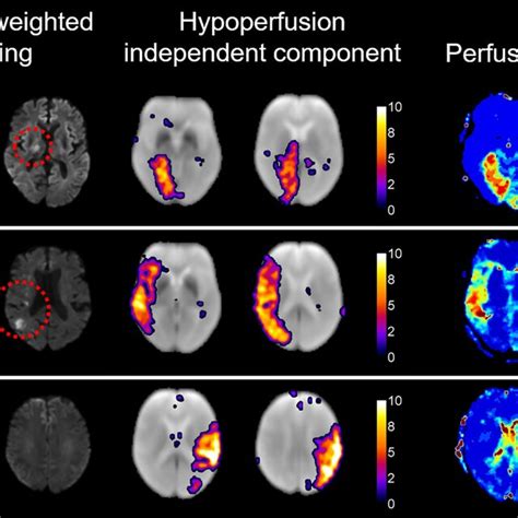 Perfusion Assessed Using Spatial Independent Component Analysis