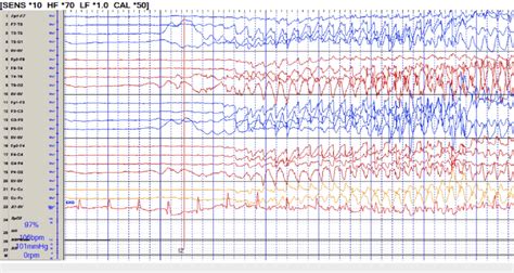Continuous Electroencephalogram EEG Showing Breakthrough Seizures In Download Scientific