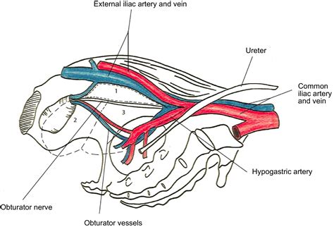 Limited Versus Extended Pelvic Lymph Node Dissection For Prostate Cancer A Randomized Clinical