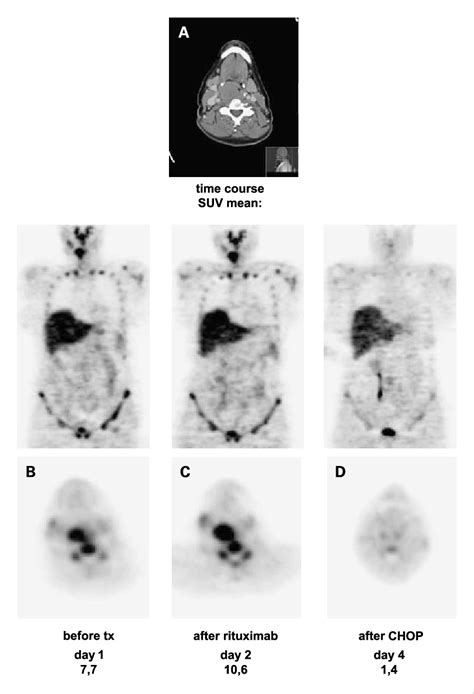 Chop Protocol Cyclophosphamide Doxorubicin Prednisone Vincristine