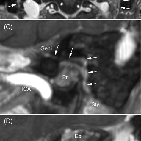3d‐gradient‐echo Images With Contrast Enhancement In Case 1 A B In