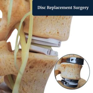 Cervical Disc Replacement Irving Tx Disc Replacement Surgery In