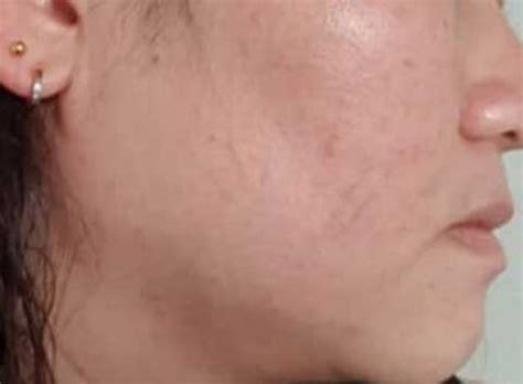 Pico Laser Eva Beauty Concept