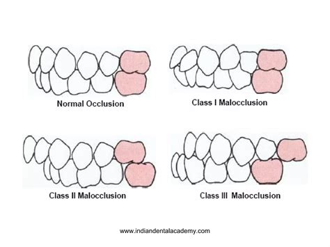 Classification Of Malocclusion Certified Fixed Orthodontic Courses By Indian Dental Academy