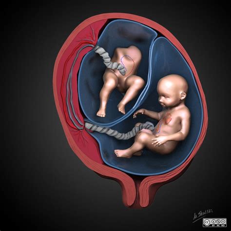 Twin Reversed Arterial Perfusion Radiology Reference Article Ultrasound