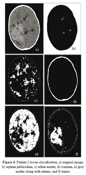 Computer Aided Diagnosis Of Brain Tumors Using Image Enhancement And Fuzzy Logic